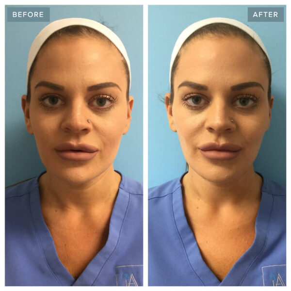 Thread Lift | FAQs + Before & After | Injectable Aesthetics