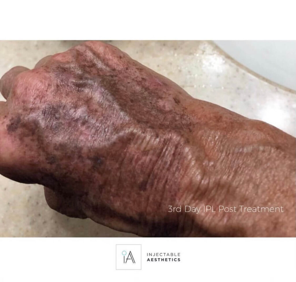 IPL Laser Treatment OKC | FAQs, Before & After | Injectable Aesthetics